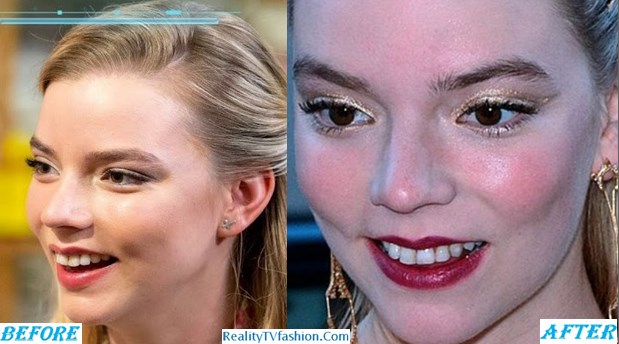 Anya Taylor-Joy Teeth Fixed, Before and After Anya Taylor-Joy Teeth Fixed, Before and After